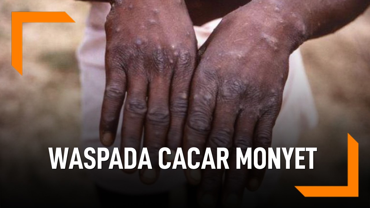 Streaming Waspada Cacar Monyet Yang Ditularkan Hewan Liar - Vidio.com